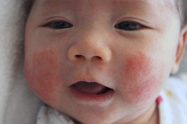 Types of Baby Rashes